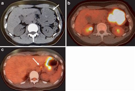 A Ct Showing A Giant Phyllodes Tumor With Calcification In The Download Scientific Diagram