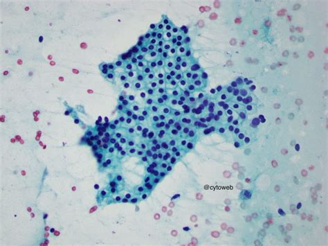 Mystery Cases Eus Fna 3 Nus Pathweb Nus Pathweb