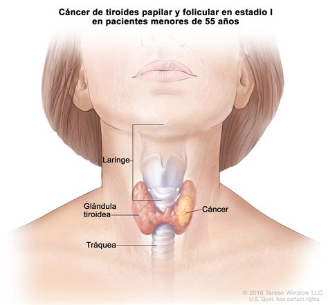 Tratamiento Del Cáncer De Tiroides En Adultos Pdq®versión Para