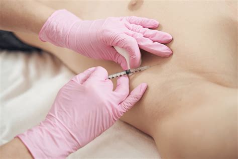 Tackling Excessive Underarm Sweating How Botox® Can Help Be