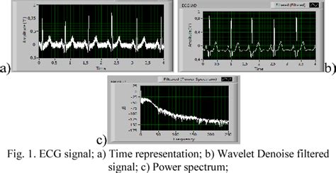 Figure 1 From Ecg Waves And Features Extraction Using Wavelet Multi Resolution Analysis