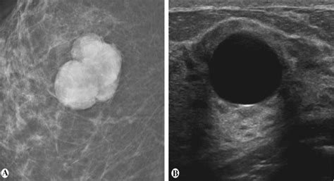A Well Defined Rounded Mass Mammogram B Absence Of Internal Echoes And Download Scientific