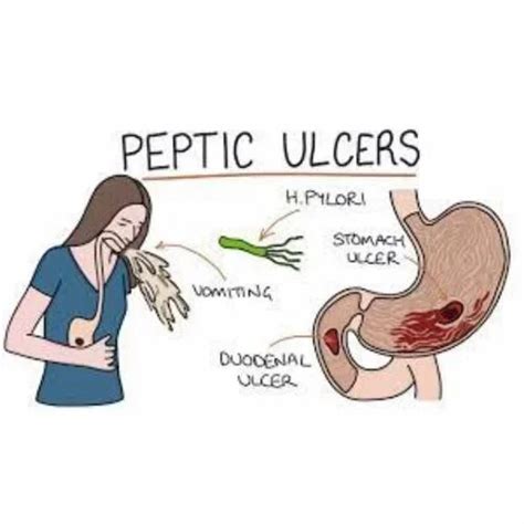 Peptic Ulcer Treatment At ₹ 20000 Session In Pune Id 2854012644448