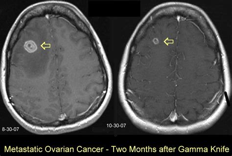 Radiosurgery For Brain Metastases