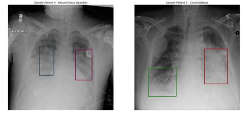 Pneumonia Detection From Chest Radiograph Cxr · Intelec Ai Blog