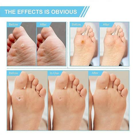 Hot Foot Corn Killer Gips Patch Plantar Calluses Remover Pad Fötter Toe
