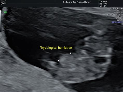 Developmental Milestones Hkog Info