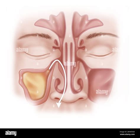Sinusitis Of The Right Maxillary Sinus The Sinus Is Filled With Mucus