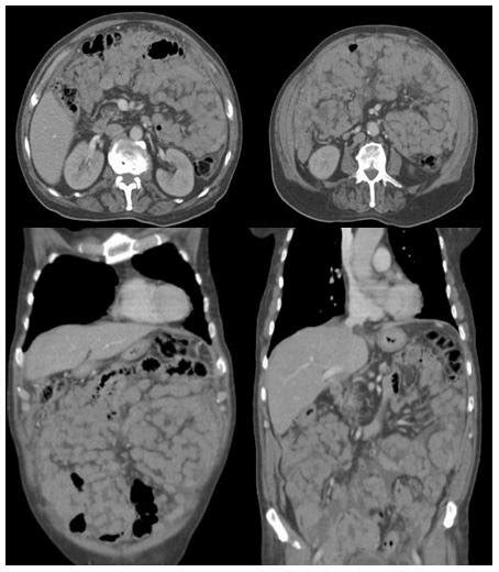 Presence Of Appeased Bowel Loops With Multiple Enlarged Mesenteric