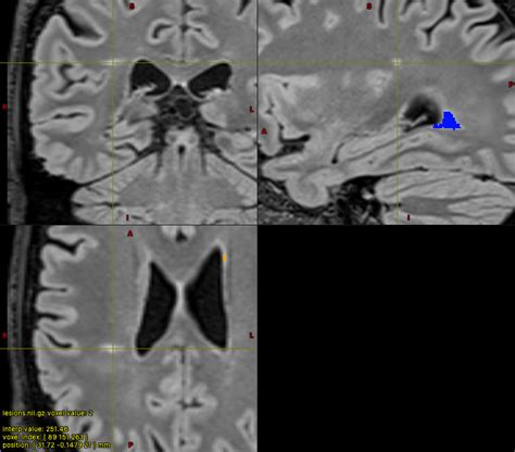 Roi Not Showing In Mrview Mrview Mrtrix3 Community