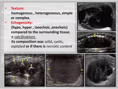 Role Of Ultrasound And Color Doppler In Evaluation Of Musculoskeletal