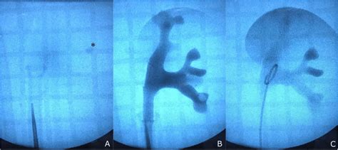 A Fluoroscopy A Radiopaque Training Stone Is Identified Download Scientific Diagram