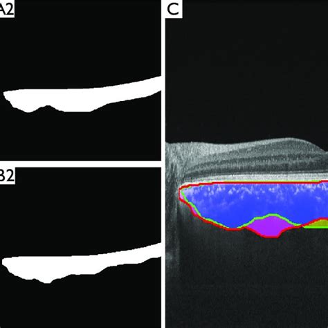 Example B Scans With Choroid Segmentation Results Overlaid The Green