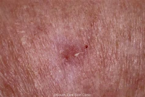 Bcc Basal Cell Carcinoma Bcc Basal Cell Carcinoma