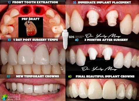 Tooth Implant Before And After