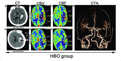 Ctp Scan From A Patient In The Hbo Group A Preoperative Left Basal Download Scientific
