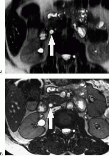 Magnetic Resonance Cholangiopancreatography Abdominal Key