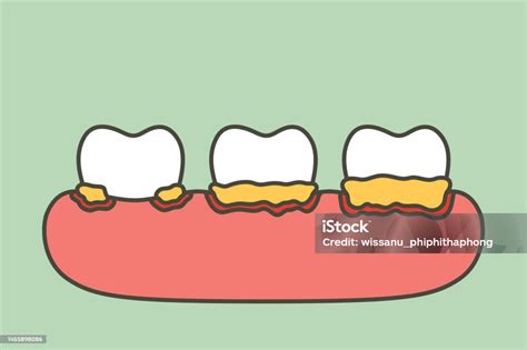 염증이 있고 혈액이 있는 치주염 또는 잇몸 질환의 단계 치과 만화 벡터 플랫 스타일 치주질환에 대한 스톡 벡터 아트 및 기타