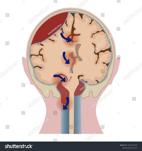 Brain Hematoma Tissue Distortion Sectioned Head Stock Vector Royalty