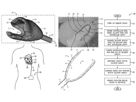 Researchers Develop Intracardiac Pulsatile Ventricular Assist Device