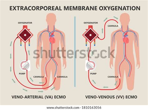 Extracorporeal Membrane Oxygenation Ecmo Life Support Stock Vector
