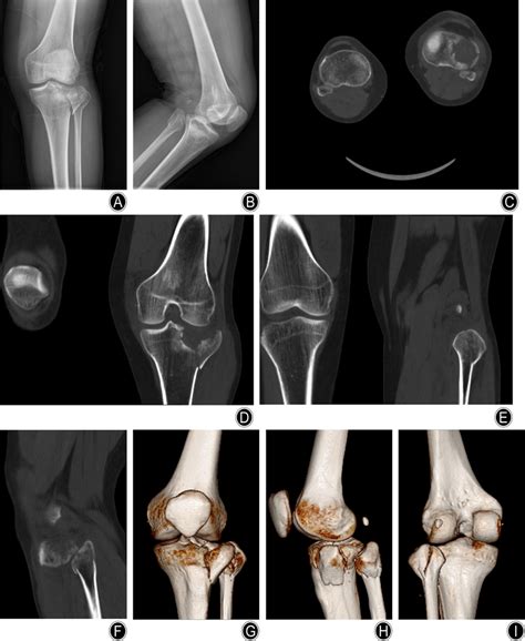 Wu Classification Of A Complex Proximal Tibia And Fibula Fracture A Download Scientific
