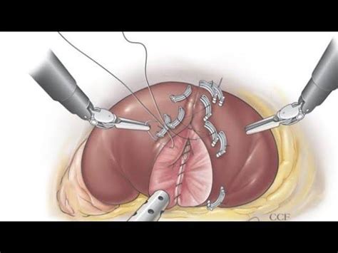 Dr Aditya Sharma On Linkedin Laparoscopic Partial Nephrectomy For Left