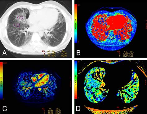 volumetric a and dynamic perfusion ct imaging b d showing the