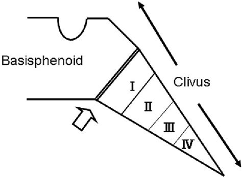 Figure 4 From Charge Syndrome Abnormal Basiocciput Development In