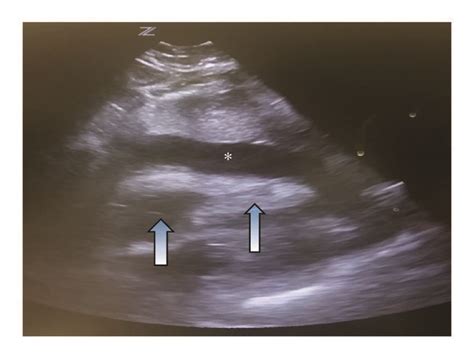 Subxiphoid Window On Bedside Echocardiography Demonstrating A Large Download Scientific Diagram