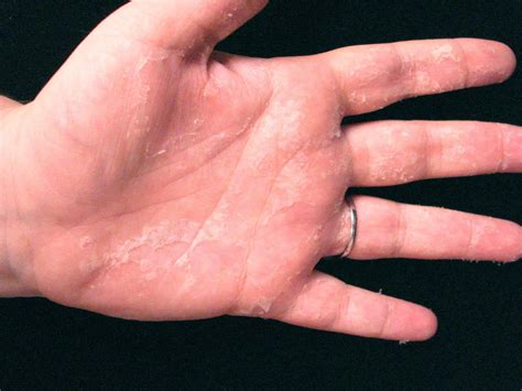 Keratolysis Exfoliativa Lamellar Dyshidrosis Recurrent 55 Off