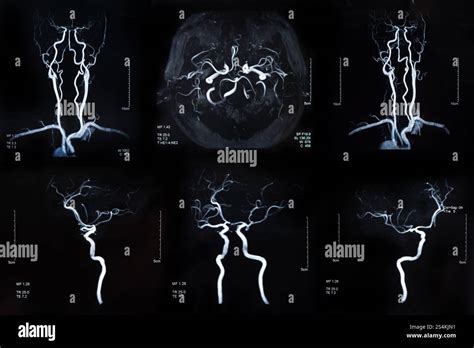 Mri Of The Brain Stroke And Cerebrovascular Disease Brain X Ray Image