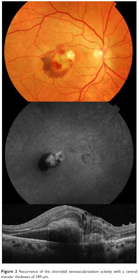 Choroidal Neovascularization After Intraocular Foreign Body Opth