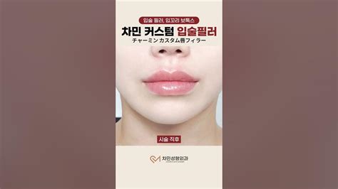 입술필러 후 모양이 마음에 들지 않는다면 입술필러 재시술도 차민 커스텀 입술필러 💋 볼륨 대칭 입꼬리 인중 축소 효과까지 한 번에 입술필러후기 러시안립필러