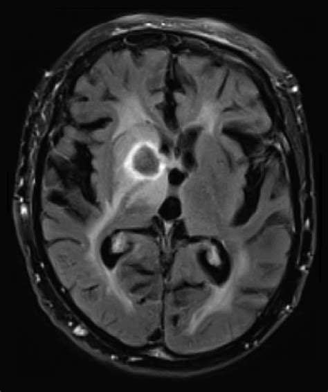 Toxoplasmosis Brain