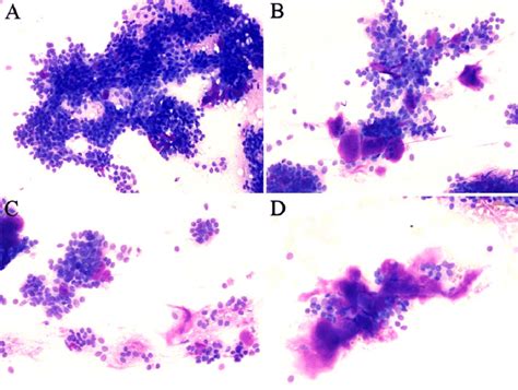 Cytomorphology Of Polymorphous Adenocarcinoma A Cohesive Group Of Download Scientific