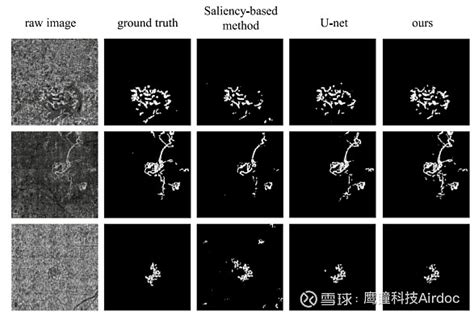 清华长庚医院联合鹰瞳airdoc研发ai新算法，可通过octa精准识别amd新生血管 年龄相关性黄斑变性（age Related Macular Degeneration Amd）是一种老年