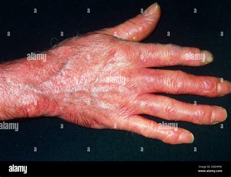 Scleroderma Red Thickened And Tough Looking Skin On The Hand Of A 52