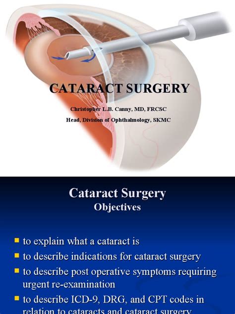 Cataract Surgery And Coding Pdf Cataract Visual System