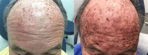 Before And After Photos — Dermassociates