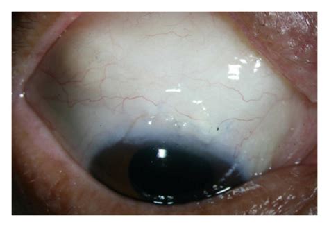Slit Lamp Photograph Of The Filtering Bleb A Bleb Photograph Taken 4 Download Scientific