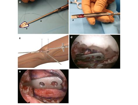 Matrix Preparation And Insertion The Matrix Is Attached To The Download Scientific Diagram
