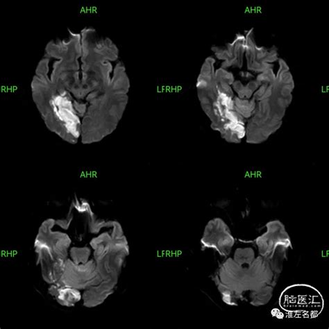影像读片（44）：颈动脉狭窄血栓脱落经后交通栓塞pca导致颞枕叶大范围梗死 脑医汇 神外资讯 神介资讯