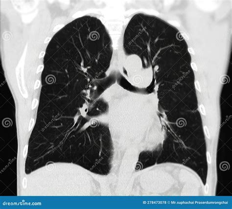 Ct Scan Of Chest Or Lung For Screening Lung Nodules And Lung Cancer