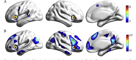 Figure 2 From The N400 In Processing Repeated Name And Pronoun Anaphors In Sentences And