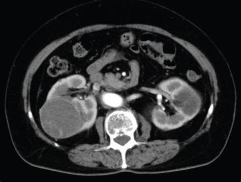 A Plain Computed Tomography Image Showing A Stone In The Right Upper Download Scientific