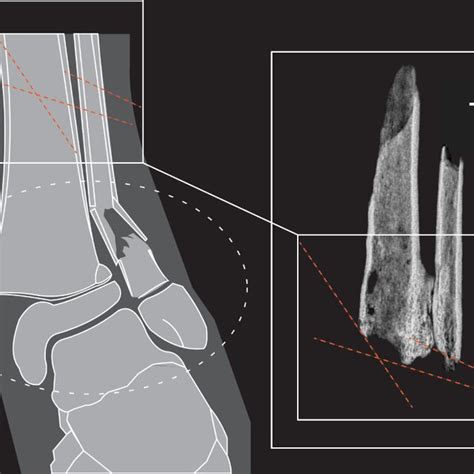 A Salterharris Type Ii Fracture Of Left Tibia And Fibula Similar To