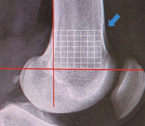 Quadrant Based Error Quantification System For The Marking The Femoral