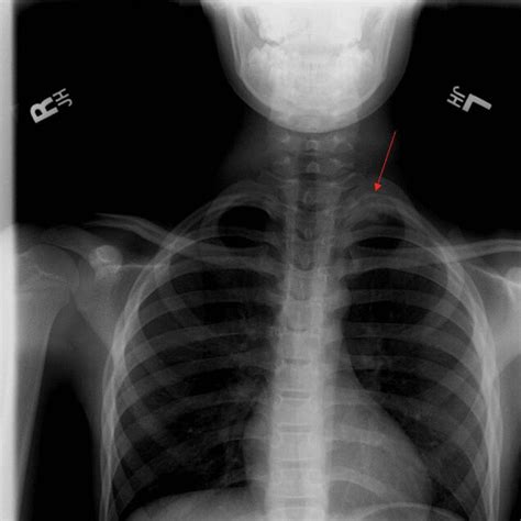 Initial Chest X Ray With Evidence Of Left First Rib Pseudoarthrosis Download Scientific Diagram