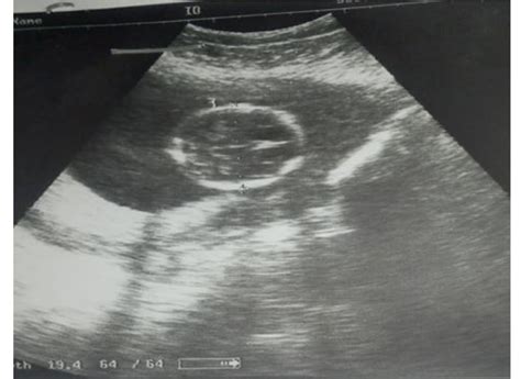 Second Ultrasound Performed Gestational Sac With Thick Wall Without